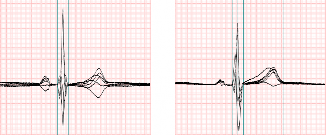 Global Median Beat Measurement - ECG Research